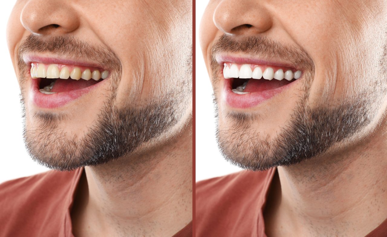 Teeth Whitening - Andrew Baderski Dental